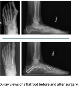 What is Flat Foot Reconstruction Surgery? - Midwest Foot & Ankle Clinics